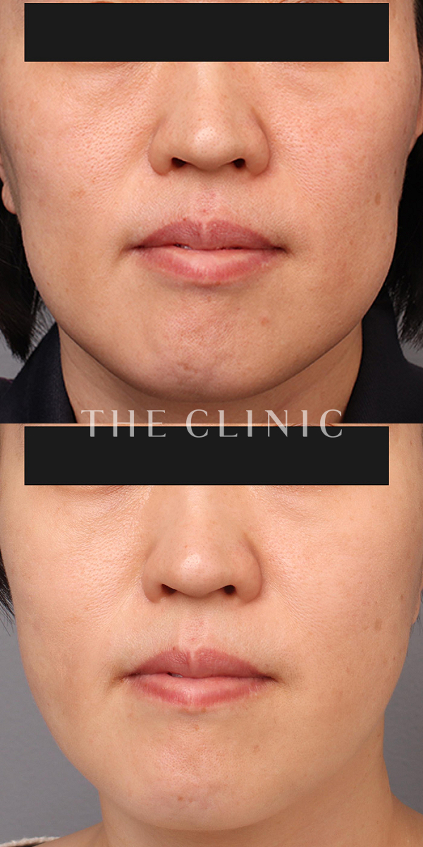 こけた頬のVOVリフト(ボブリフト・プレミアム)症例写真 No.1458 | THE CLINIC（ザクリニック）【公式】