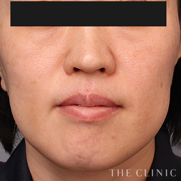 こけた頬のVOVリフト(ボブリフト・プレミアム)症例写真 No.1458 | THE CLINIC（ザクリニック）【公式】